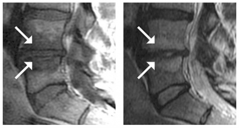 Intracept – Axis Spine Center